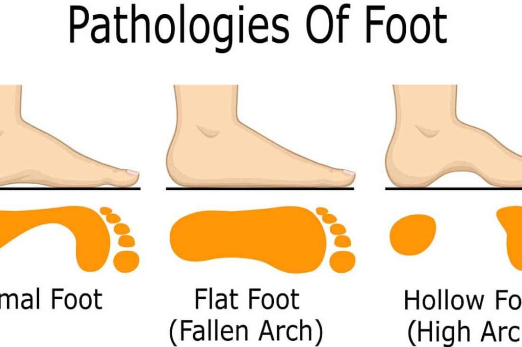 High Arch and Flat Footers | Ezfit Singapore